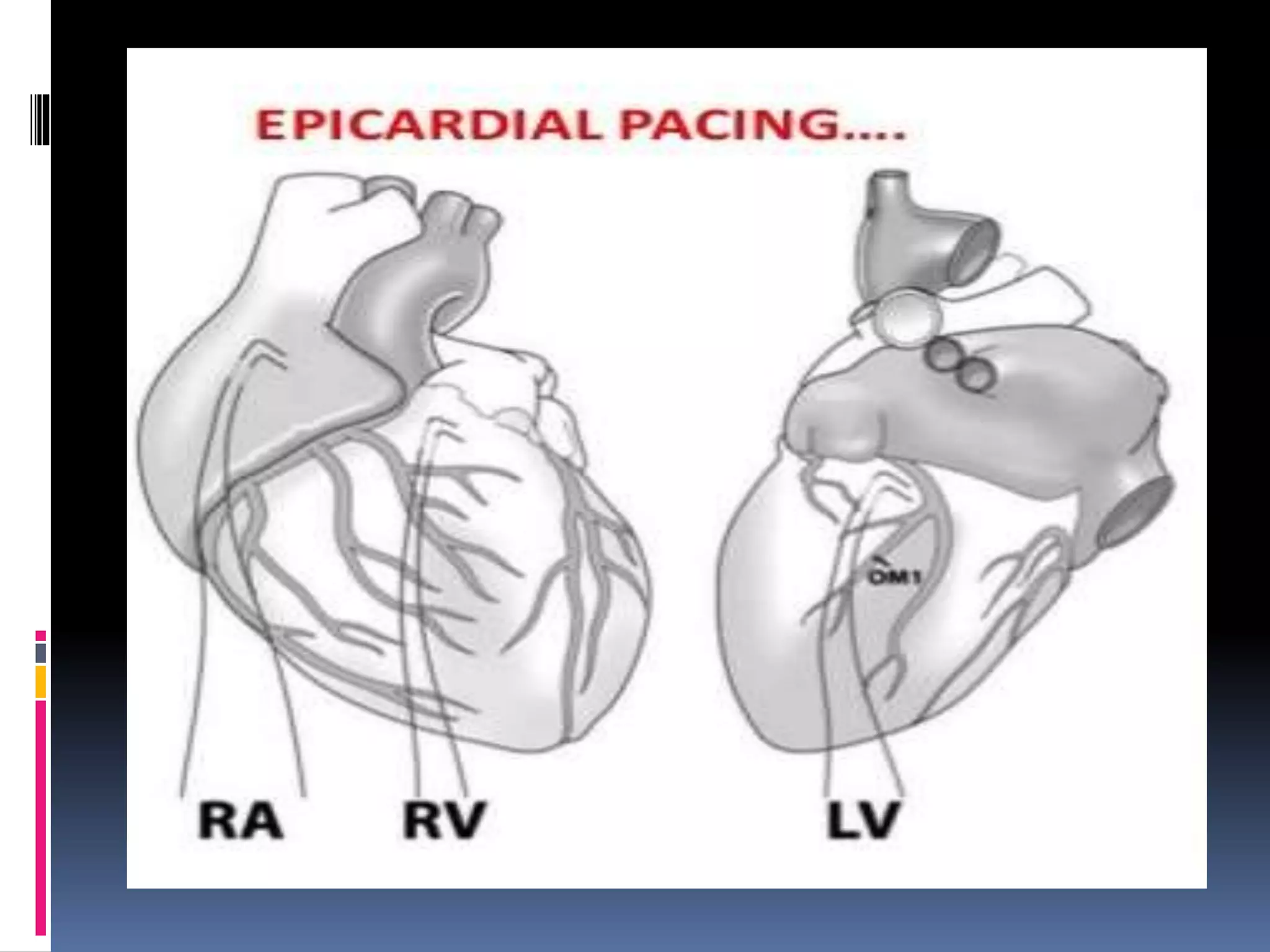 Pacemaker powerpoint presentation med surg | PPTX