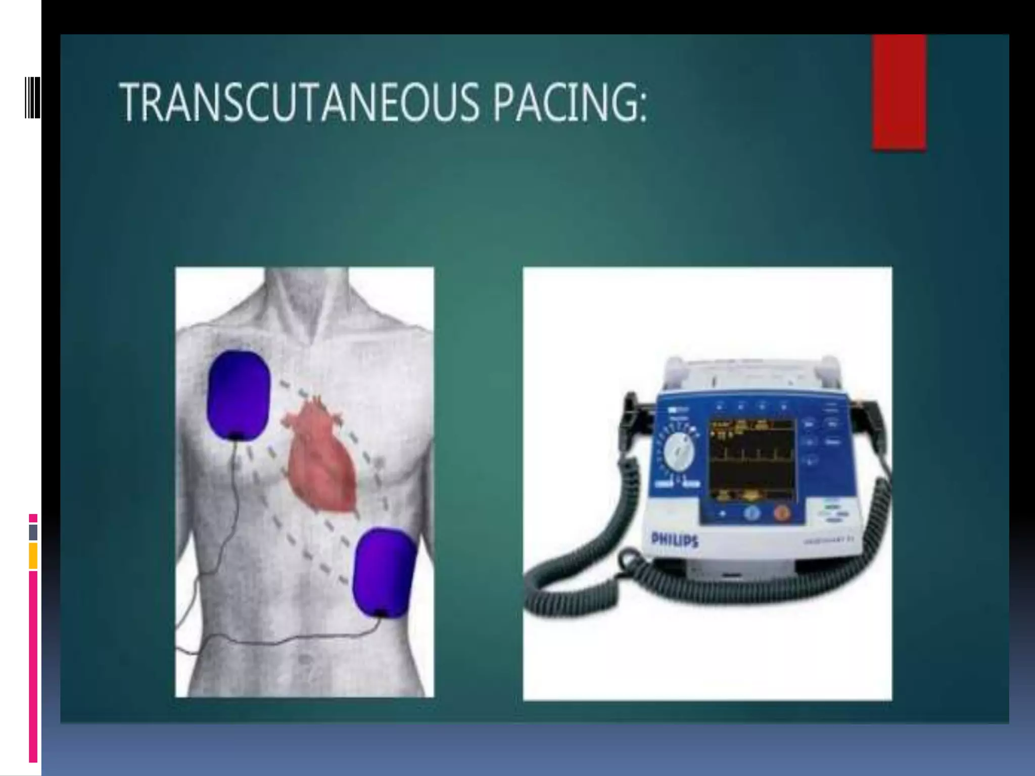Pacemaker powerpoint presentation med surg | PPTX