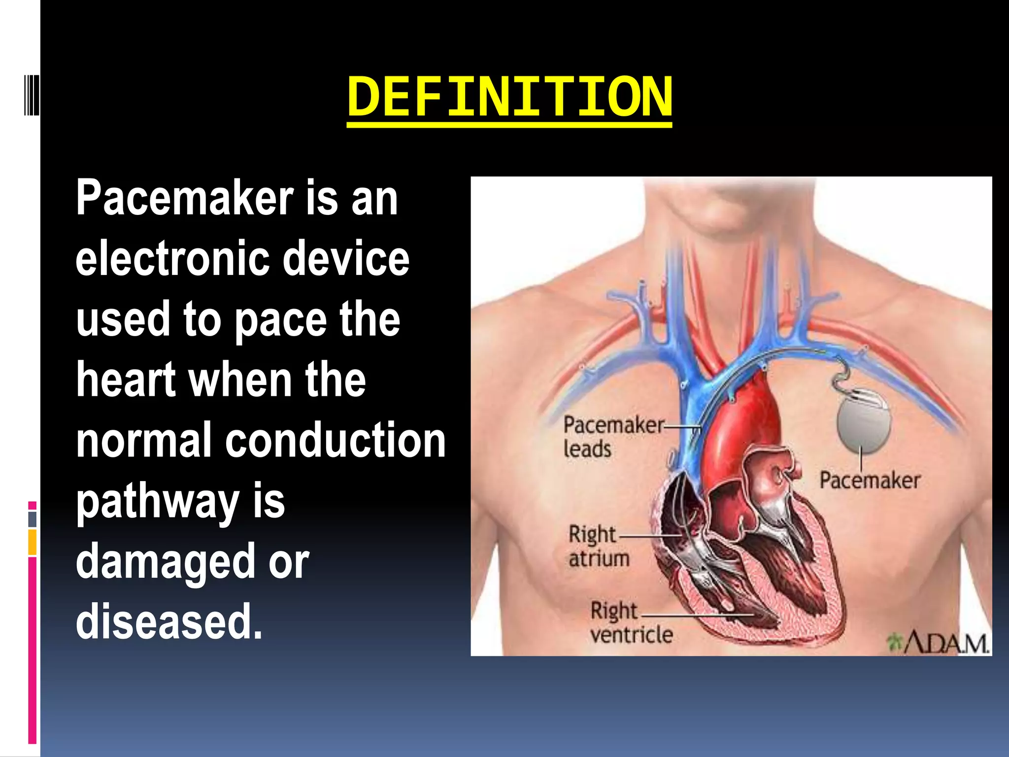 Pacemaker powerpoint presentation med surg | PPTX