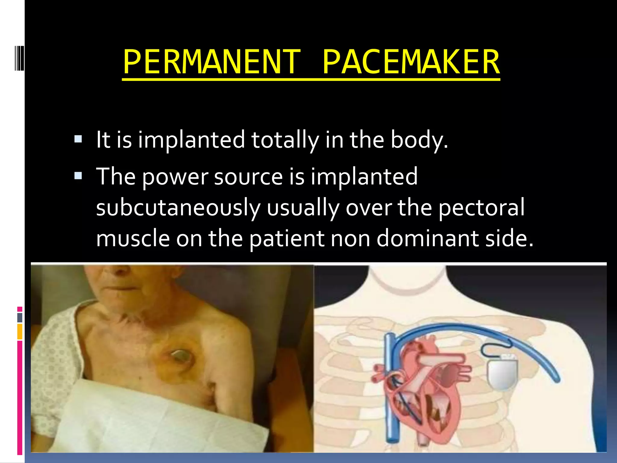 Pacemaker powerpoint presentation med surg | PPTX