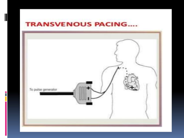 Pacemaker powerpoint presentation med surg | PPTX | Heart and Cardiovascular Diseases | Diseases ...