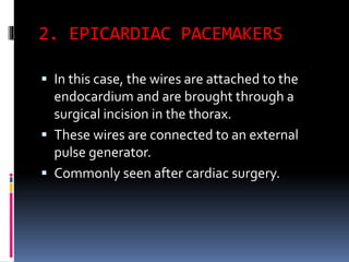 Pacemaker powerpoint presentation med surg | PPTX