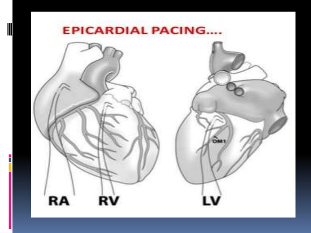 Pacemaker powerpoint presentation med surg | PPTX | Heart and ...