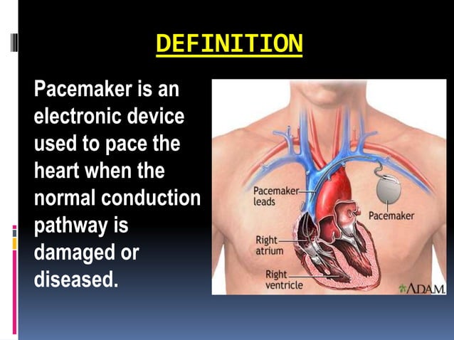 Pacemaker powerpoint presentation med surg | PPTX | Heart and Cardiovascular Diseases | Diseases ...