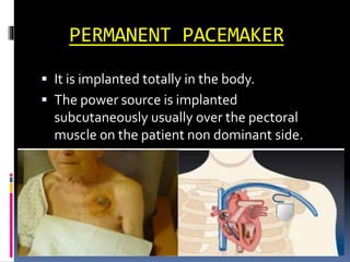 Pacemaker powerpoint presentation med surg | PPTX