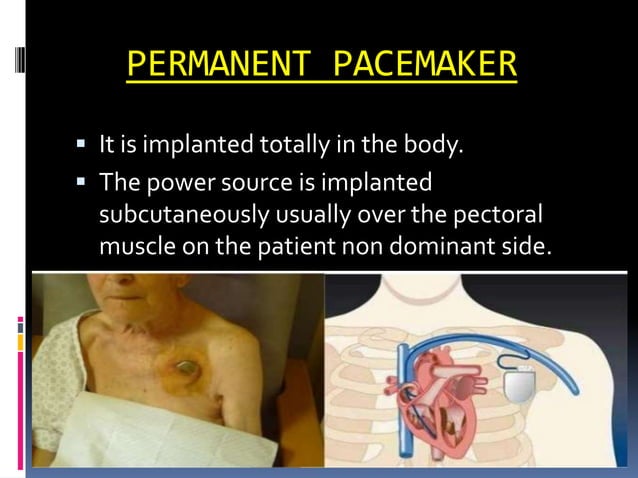 Pacemaker powerpoint presentation med surg | PPTX | Heart and ...