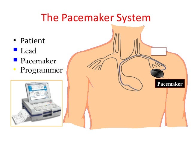 Pacemaker implantation in India