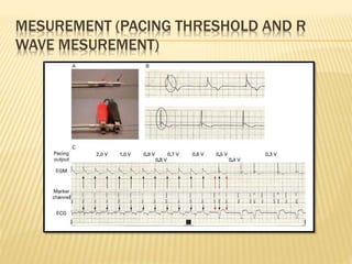 Pacemaker implantation technique waleed roshdy | PPTX