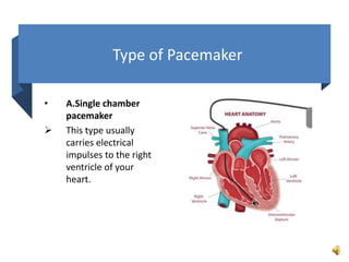 Pacemaker | PPTX