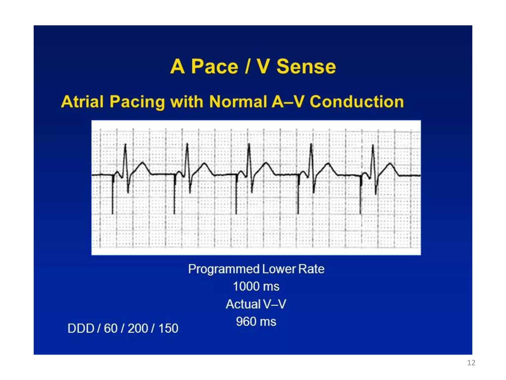 Evaluation and management of Pacemaker malfunction | PPTX