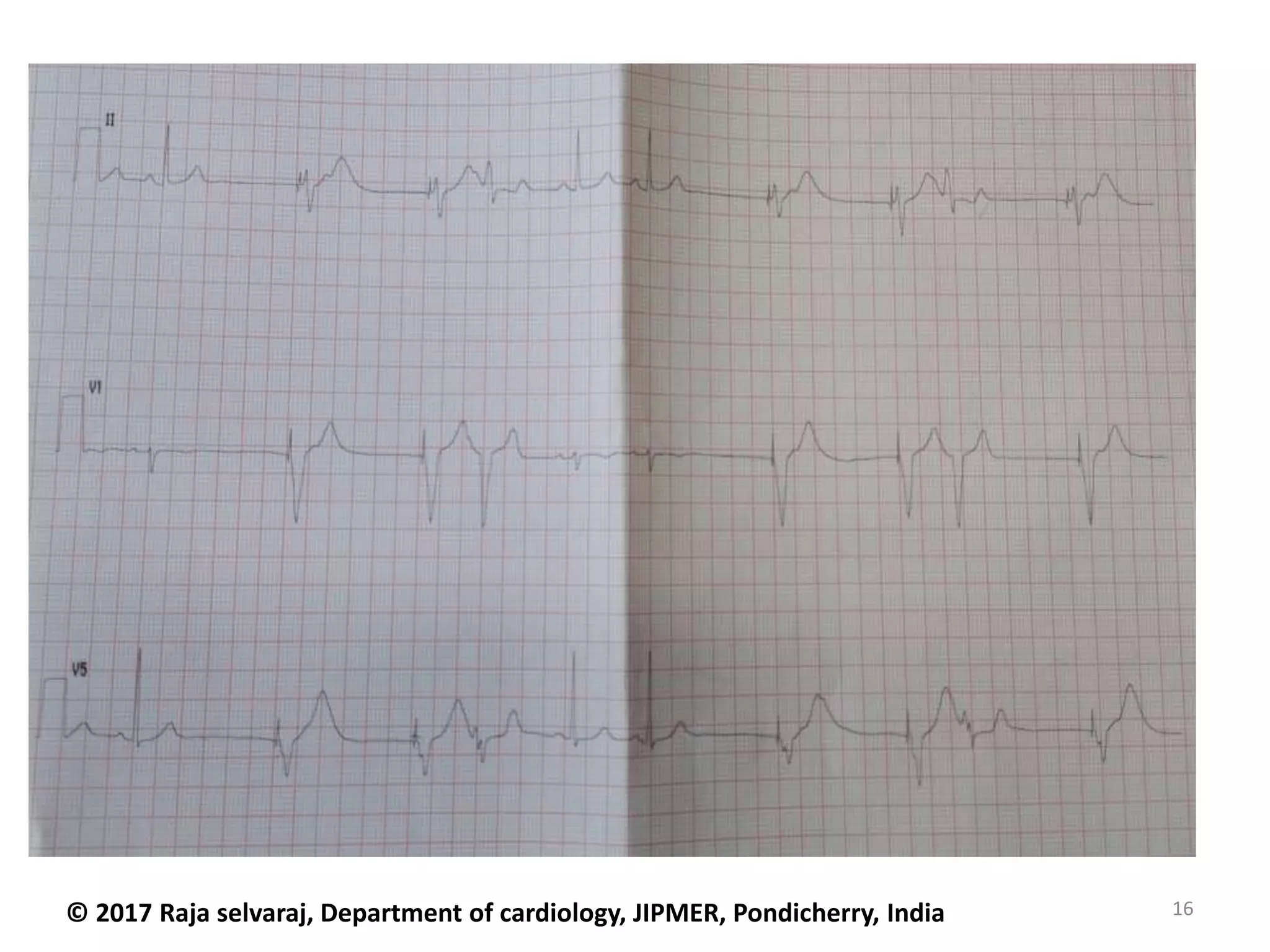 Evaluation and management of Pacemaker malfunction | PPTX