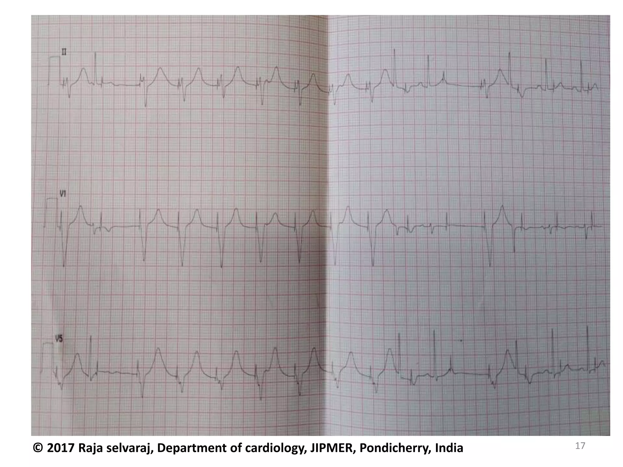 Evaluation and management of Pacemaker malfunction | PPTX