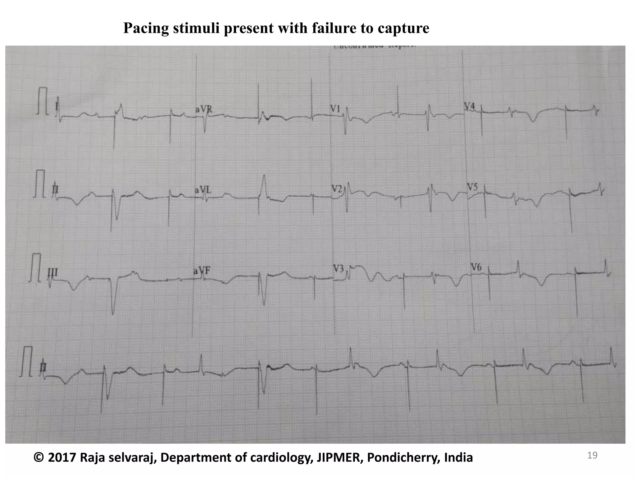Evaluation and management of Pacemaker malfunction | PPTX