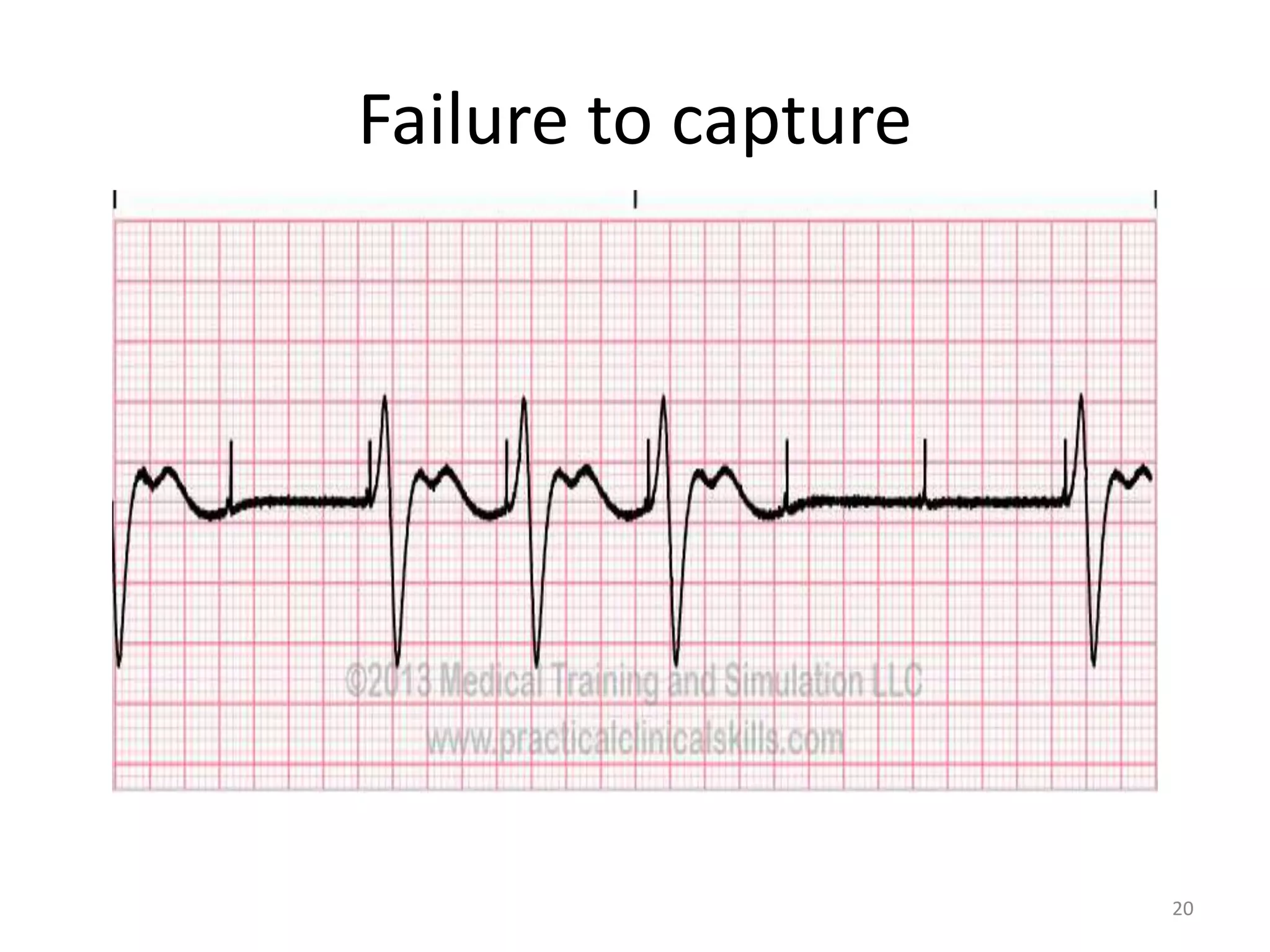 Evaluation and management of Pacemaker malfunction | PPTX