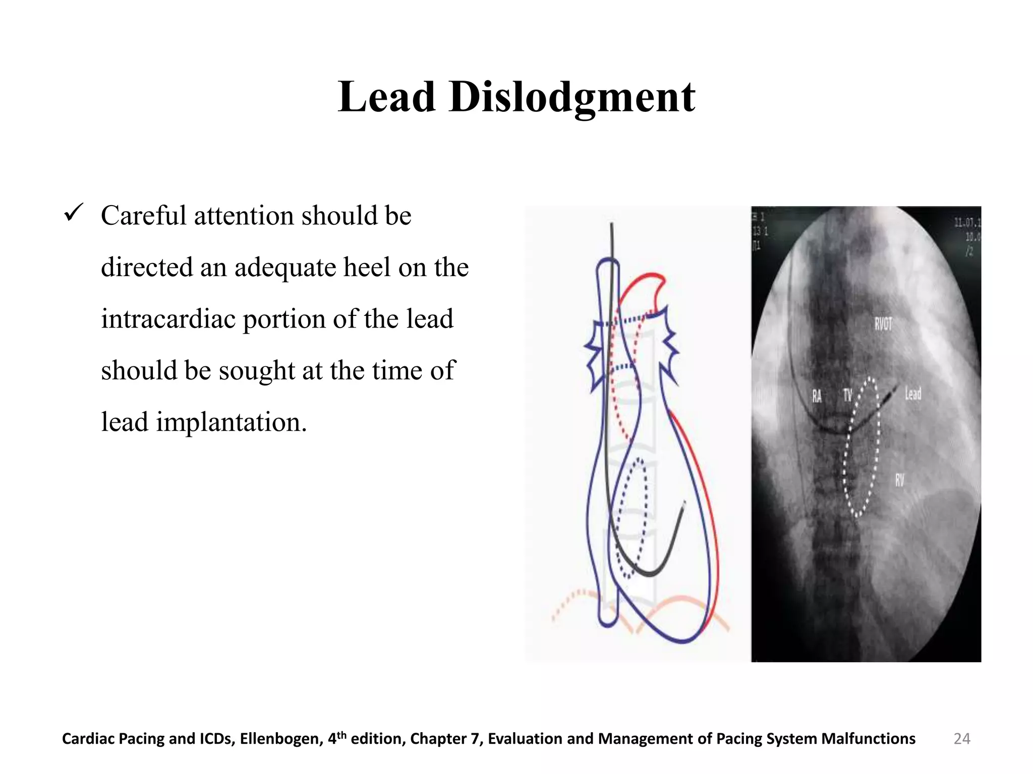 Evaluation and management of Pacemaker malfunction | PPTX
