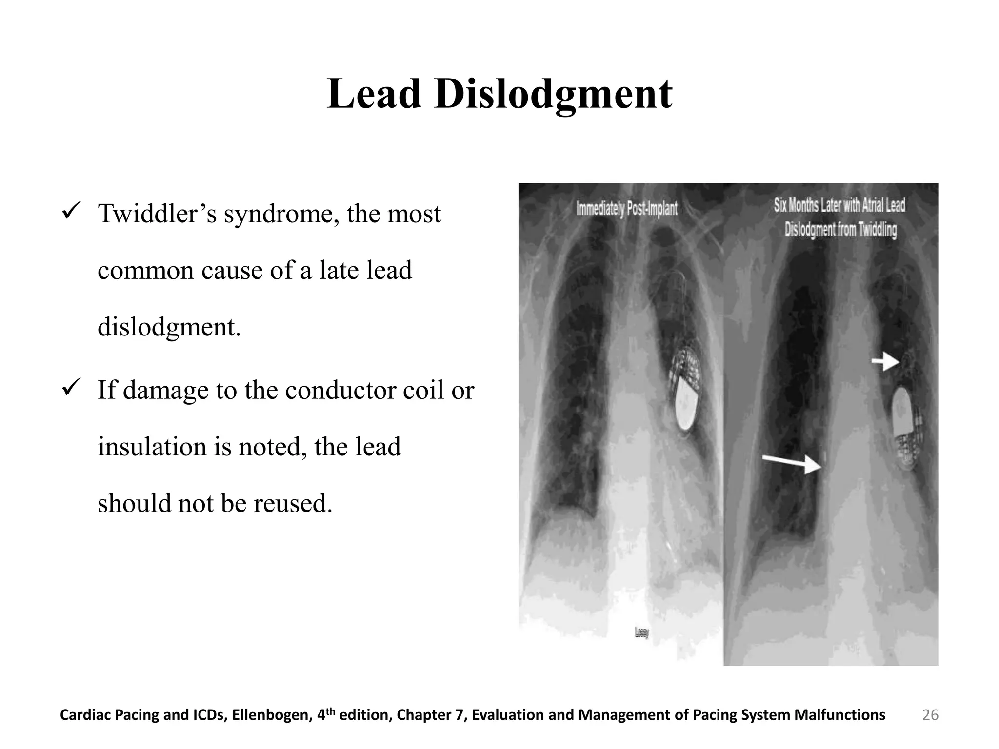 Evaluation and management of Pacemaker malfunction | PPTX