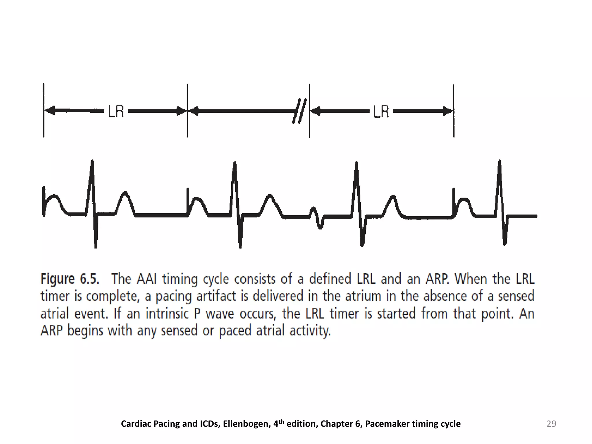 Evaluation and management of Pacemaker malfunction | PPTX