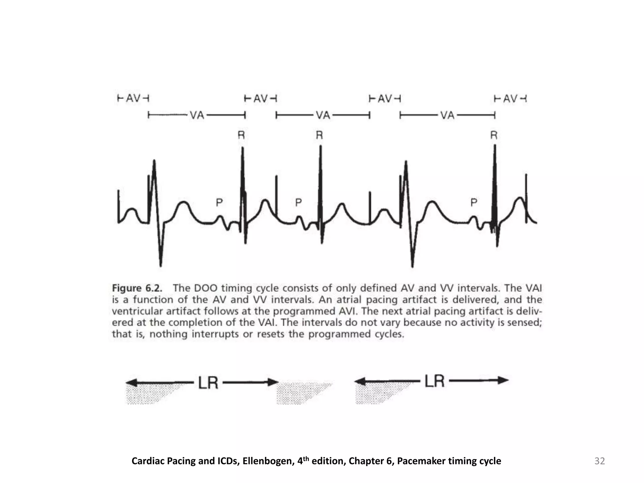 Evaluation and management of Pacemaker malfunction | PPTX