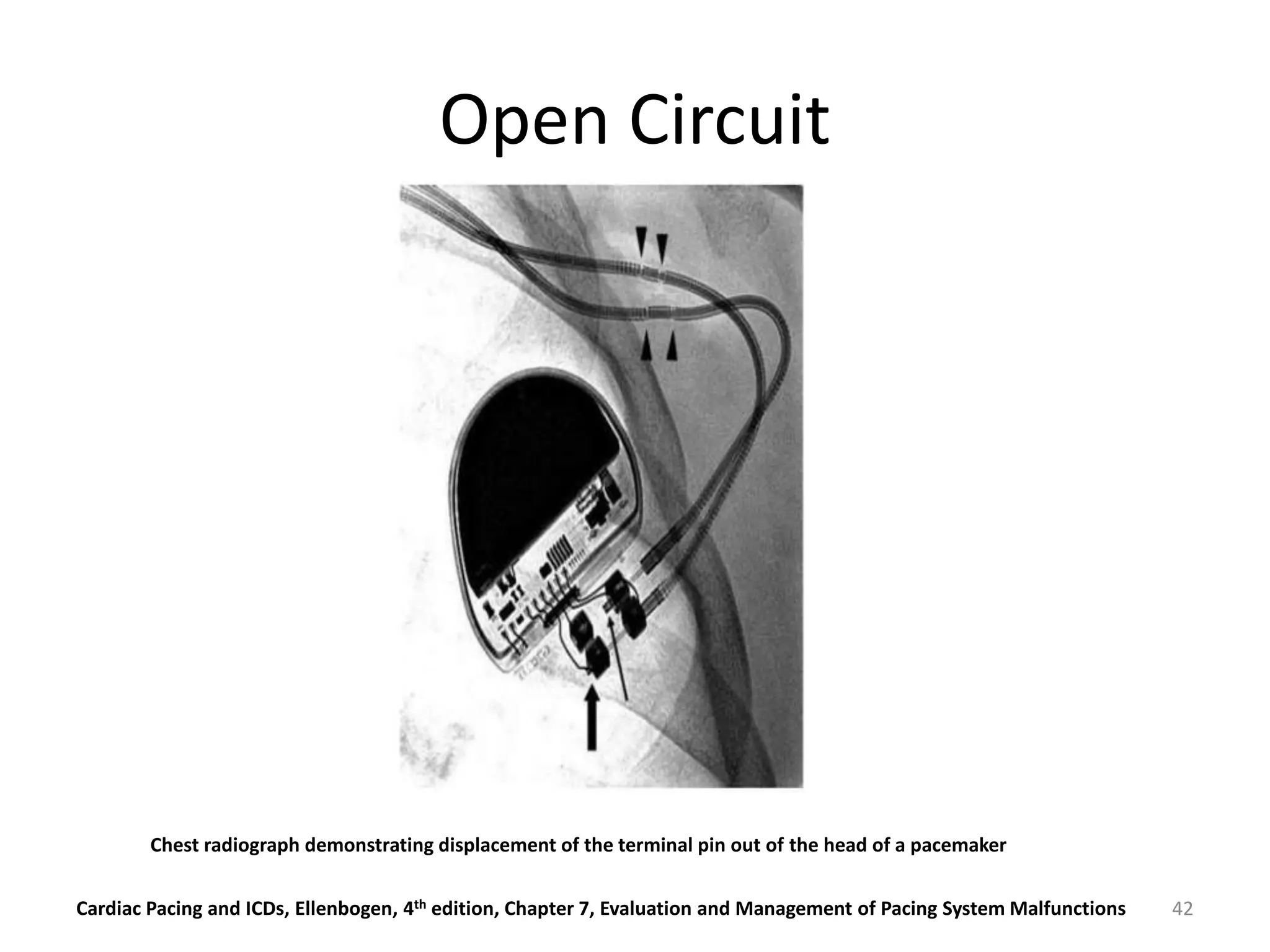 Evaluation and management of Pacemaker malfunction | PPTX