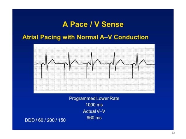 Evaluation and management of Pacemaker malfunction | PPTX | Heart and ...