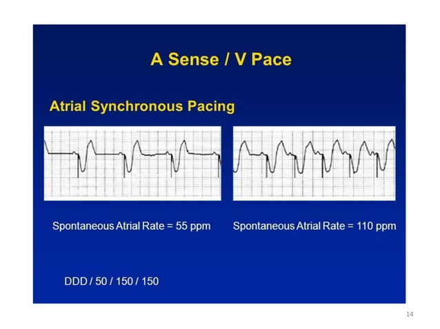 Evaluation and management of Pacemaker malfunction | PPTX | Heart and ...
