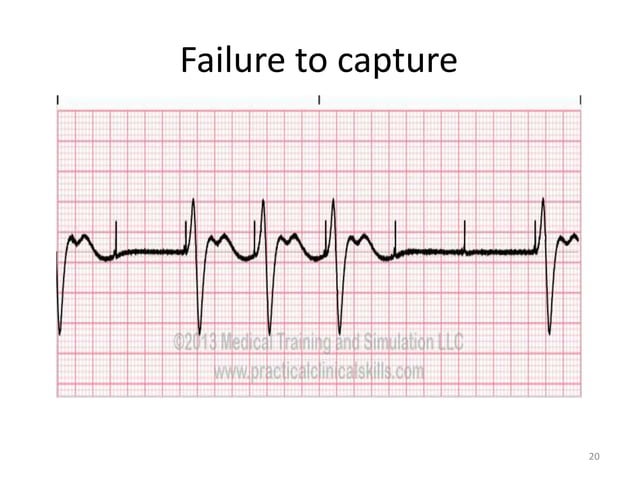 Evaluation and management of Pacemaker malfunction | PPTX | Heart and ...