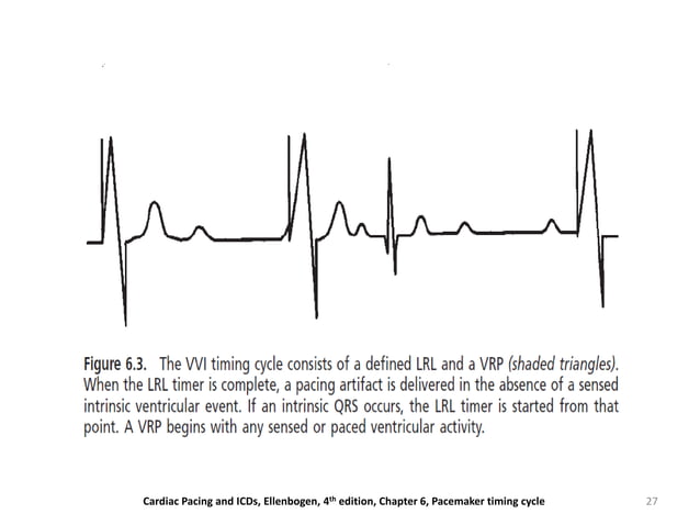Evaluation and management of Pacemaker malfunction | PPTX | Heart and ...