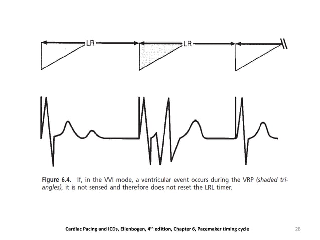 Evaluation and management of Pacemaker malfunction | PPTX | Heart and ...