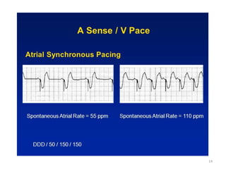 Pacemaker Failure To Capture