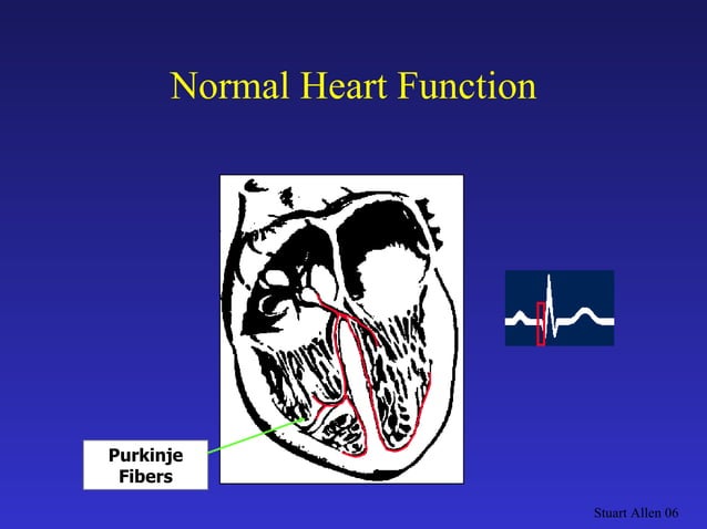 Pacemaker Overview | PPT | Heart and Cardiovascular Diseases | Diseases ...