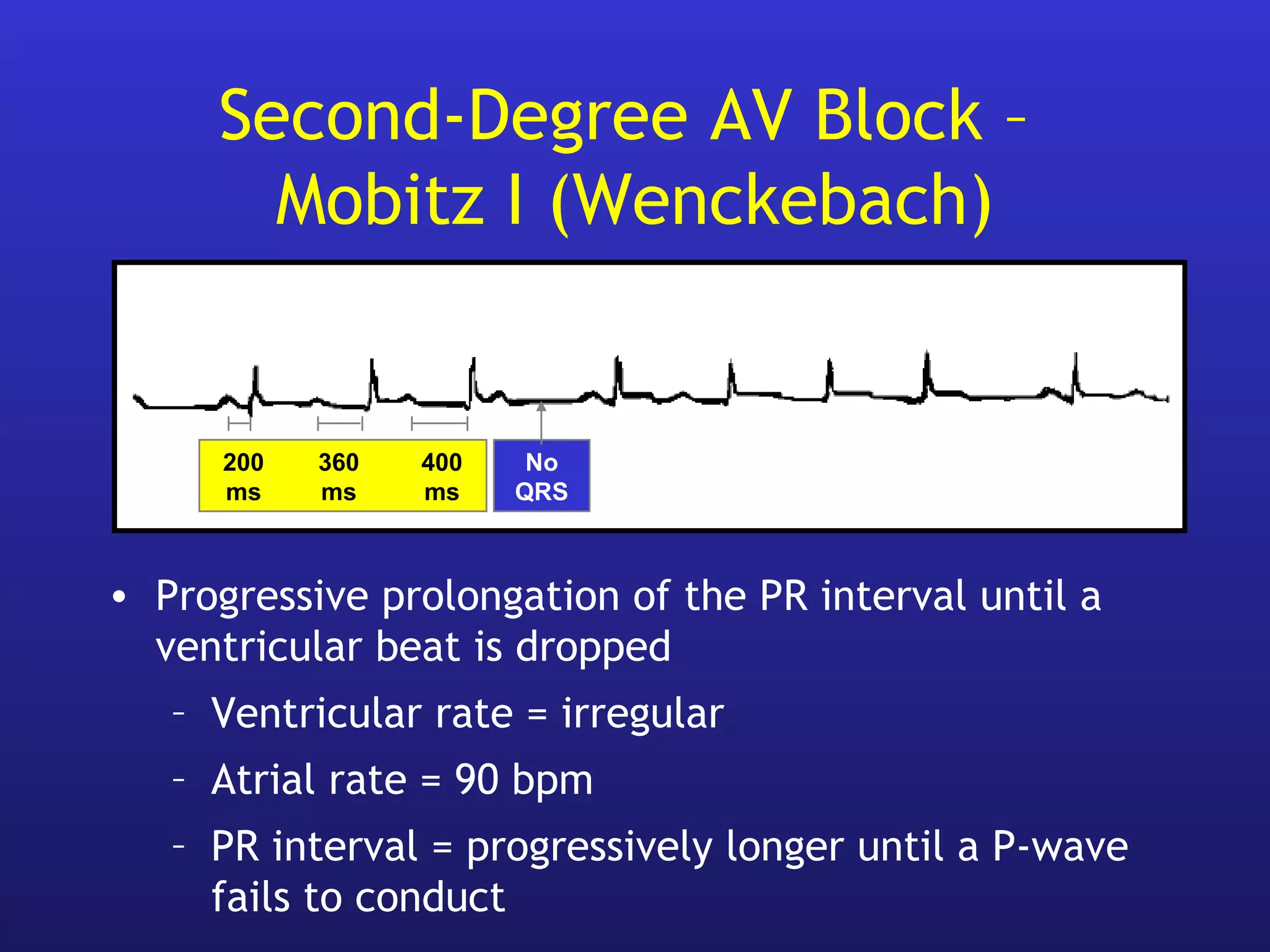 Pacemaker overview | PPT