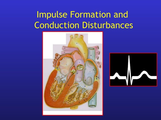 Pacemaker overview | PPT