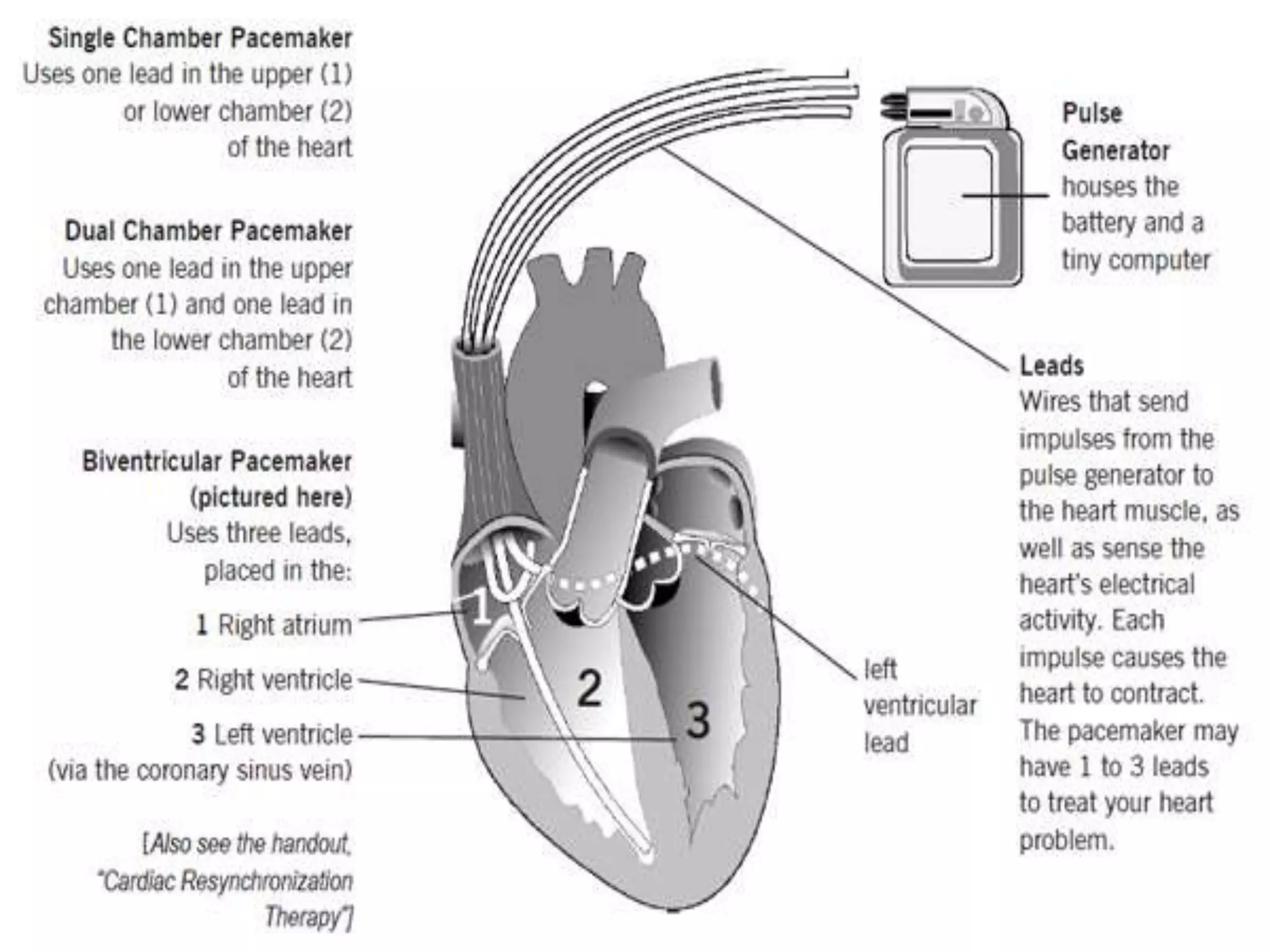 Pacemaker Implant | PPTX