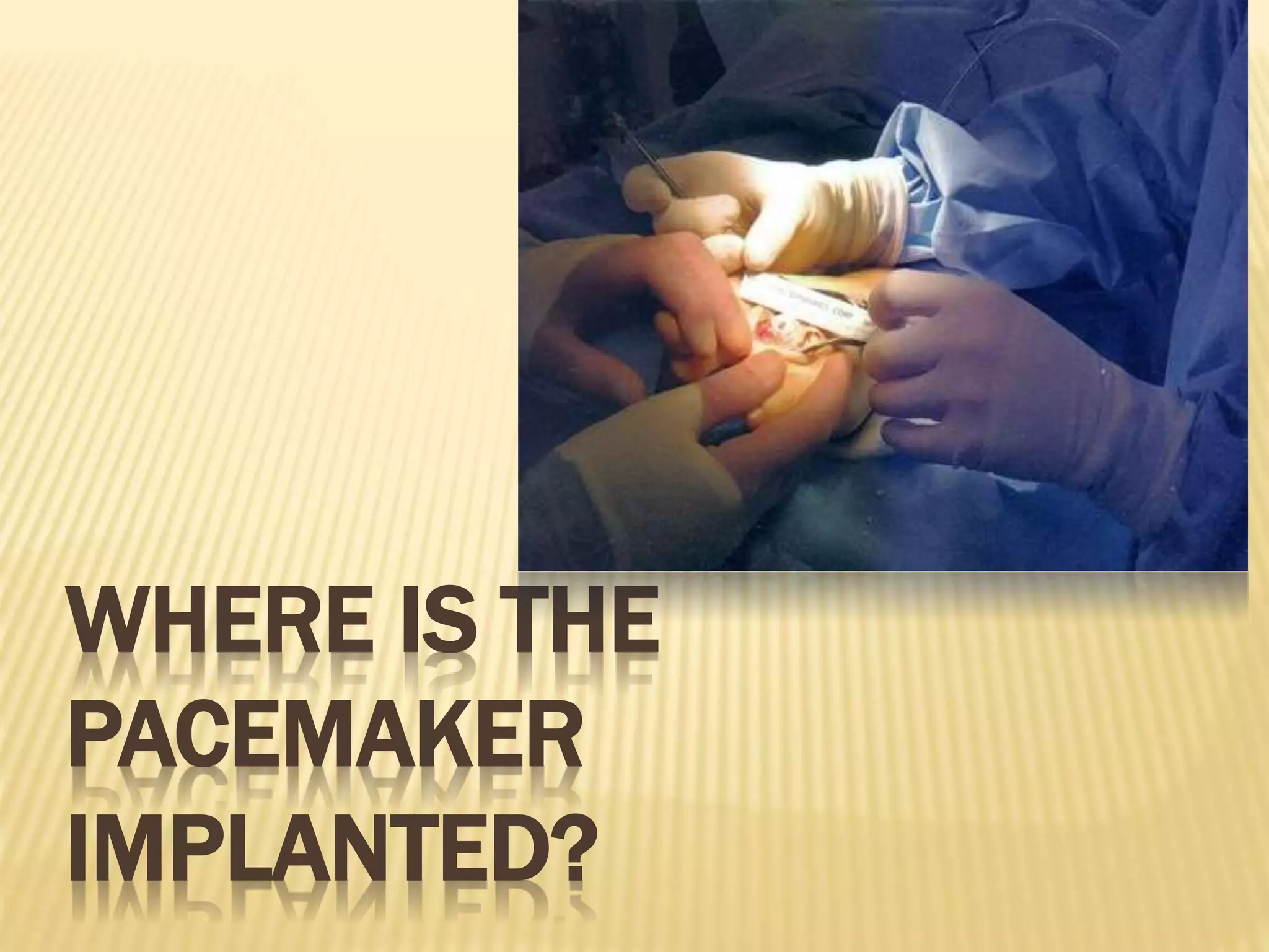 Pacemaker Implant | PPTX