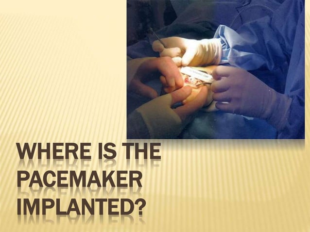 Pacemaker Implant | PPTX | Heart and Cardiovascular Diseases | Diseases ...