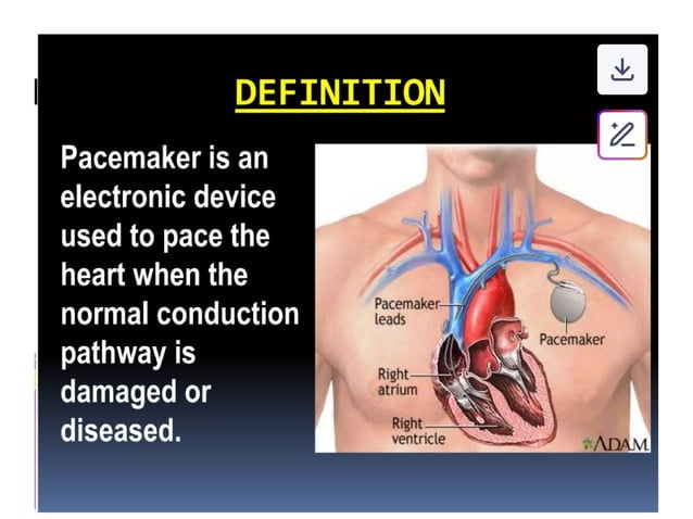 Pacemaker_Presentation .pptx