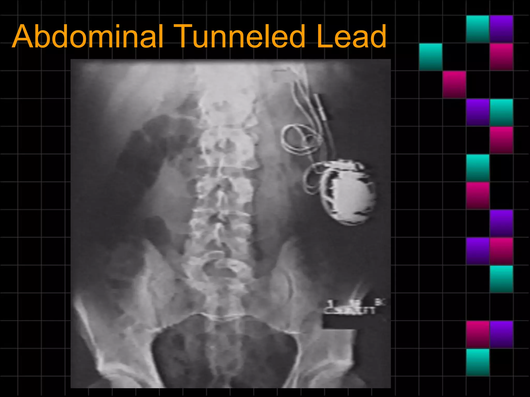Pacemaker radiologyanintroduction | PPT