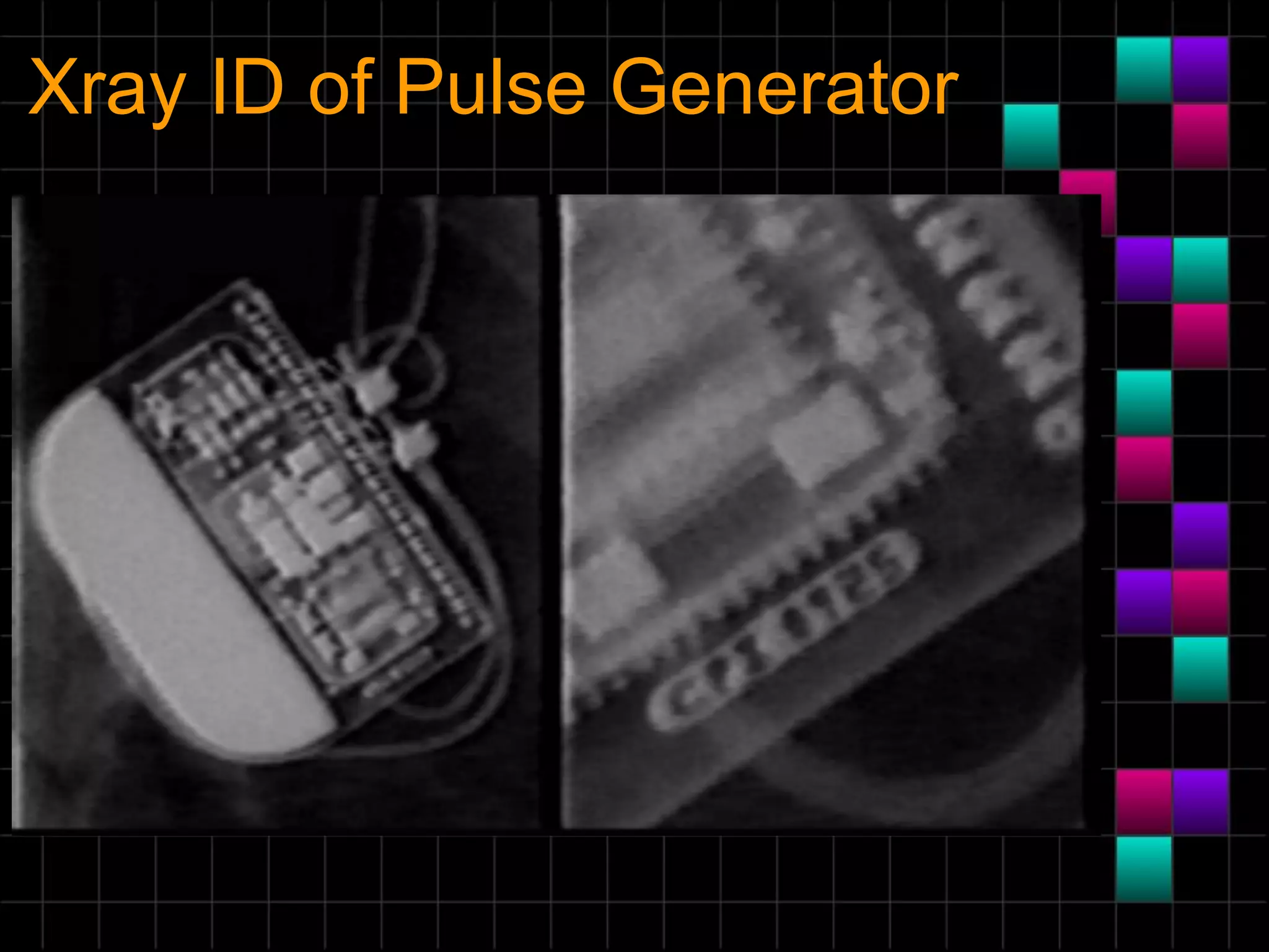 Pacemaker radiologyanintroduction | PPT