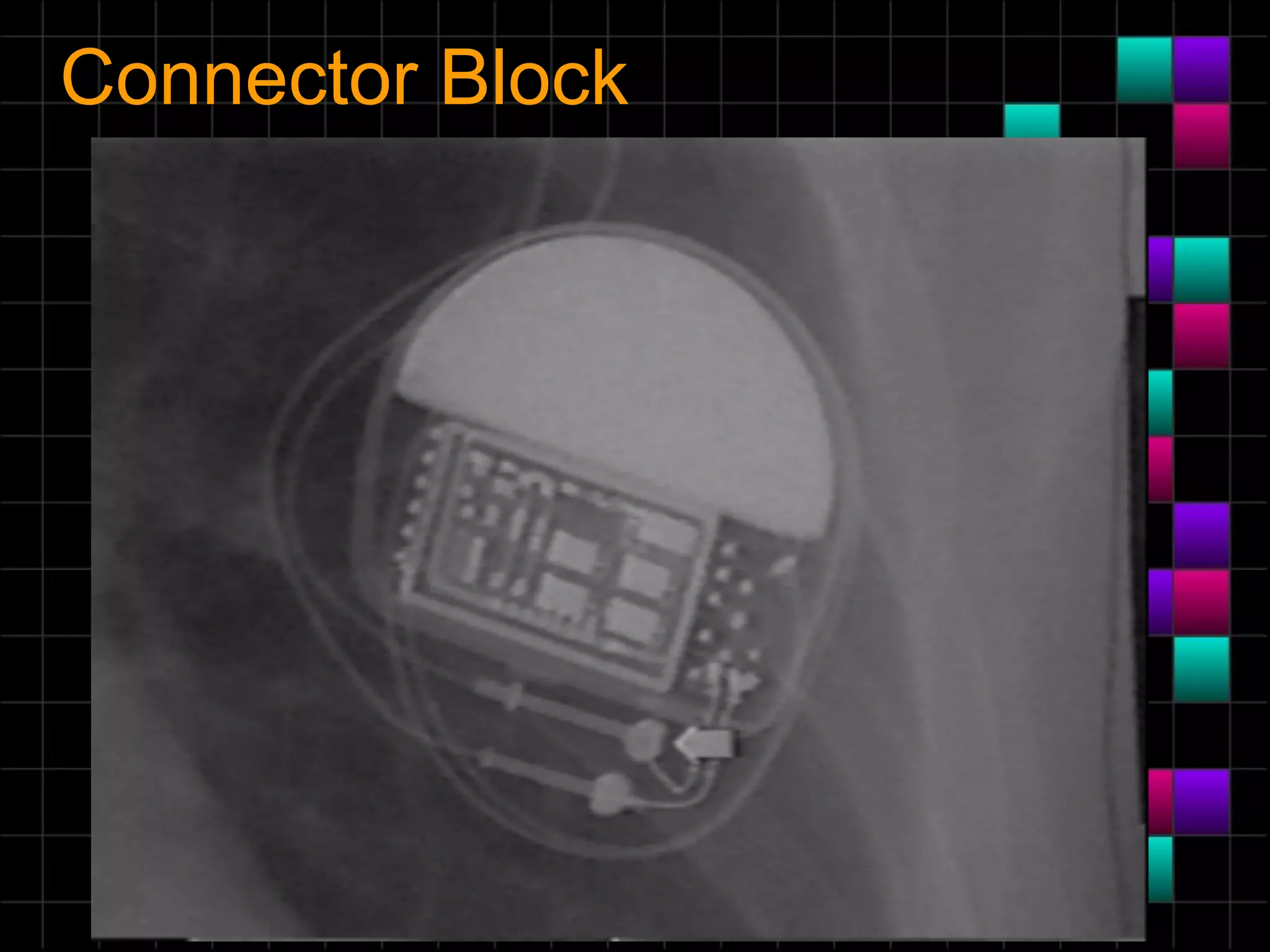 Pacemaker radiologyanintroduction | PPT