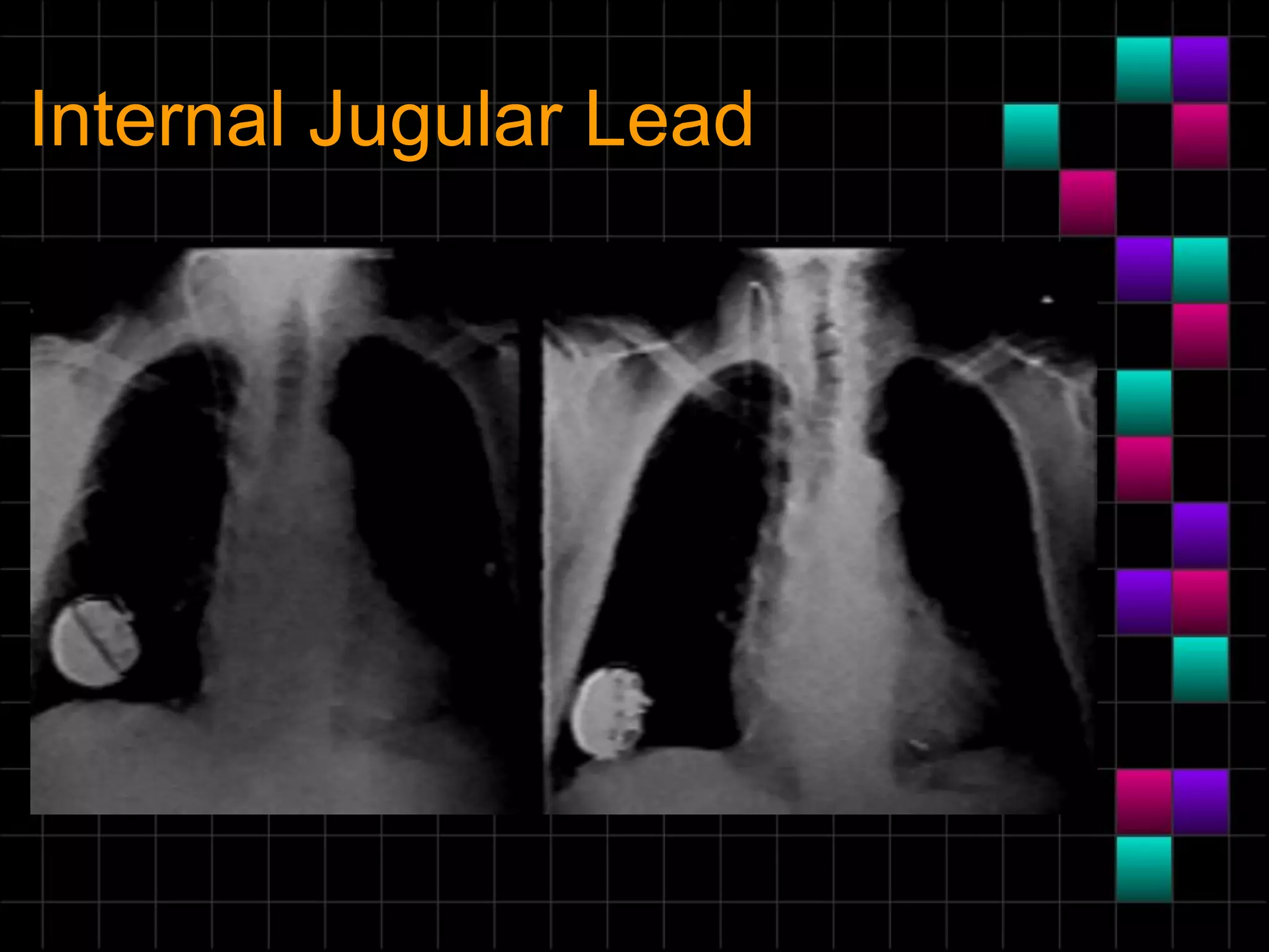 Pacemaker radiologyanintroduction | PPT