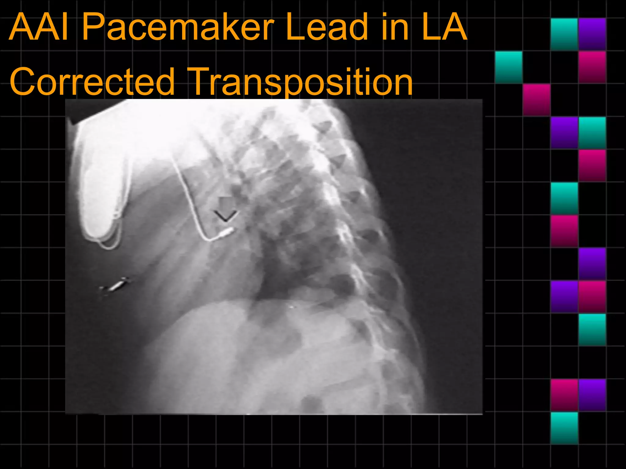 Pacemaker radiologyanintroduction | PPT