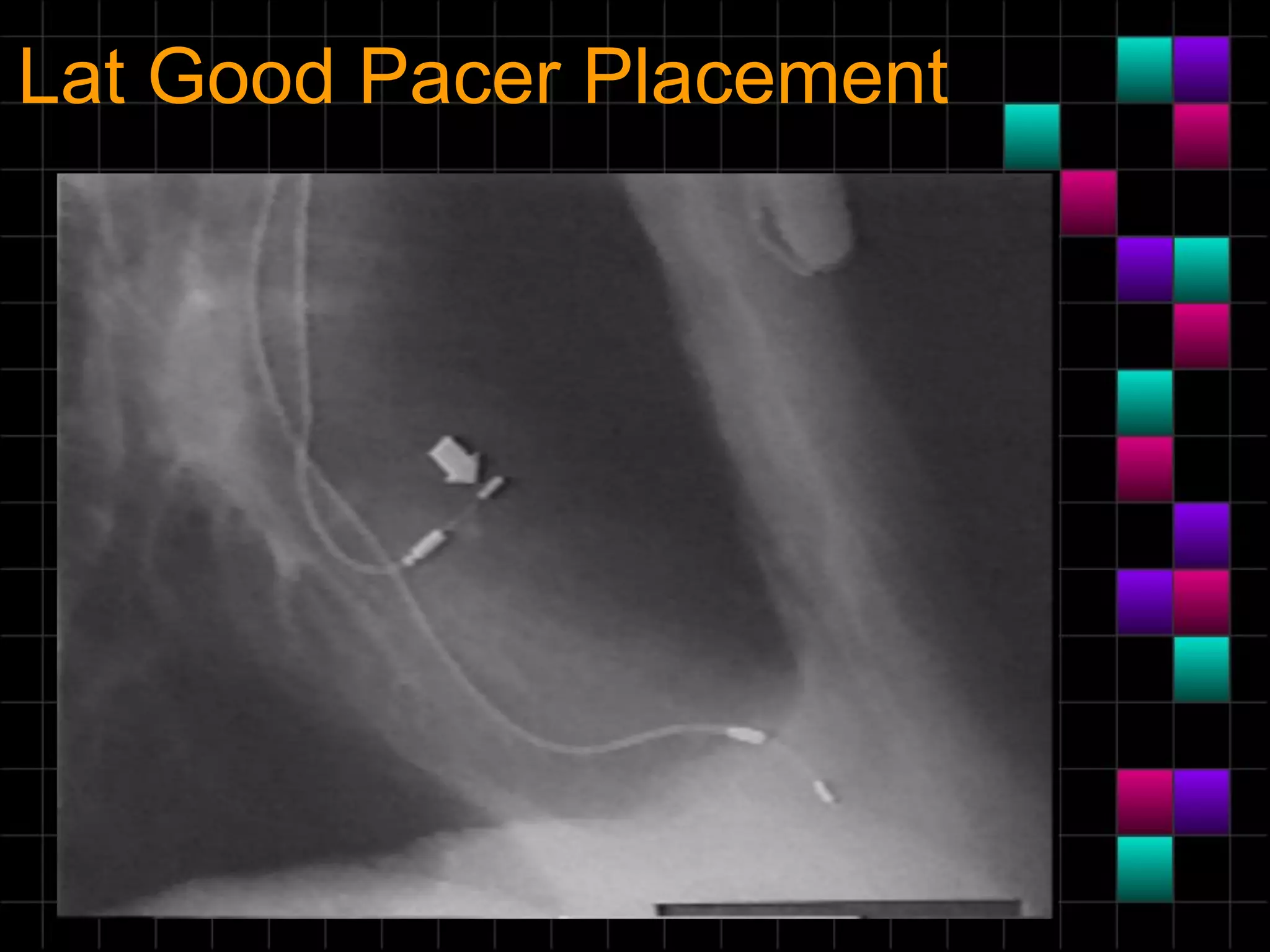 Pacemaker radiologyanintroduction | PPT