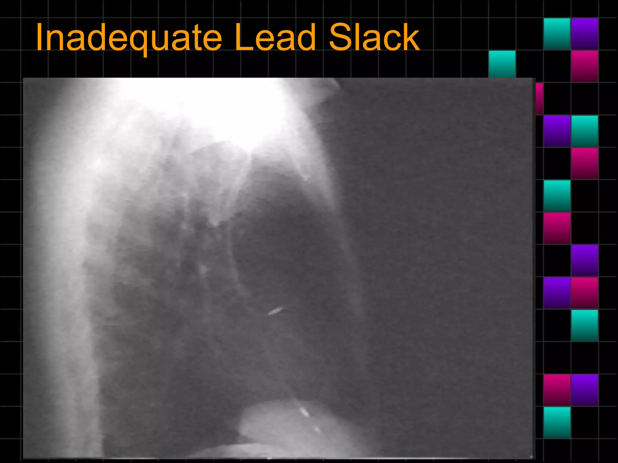 Pacemaker radiologyanintroduction | PPT