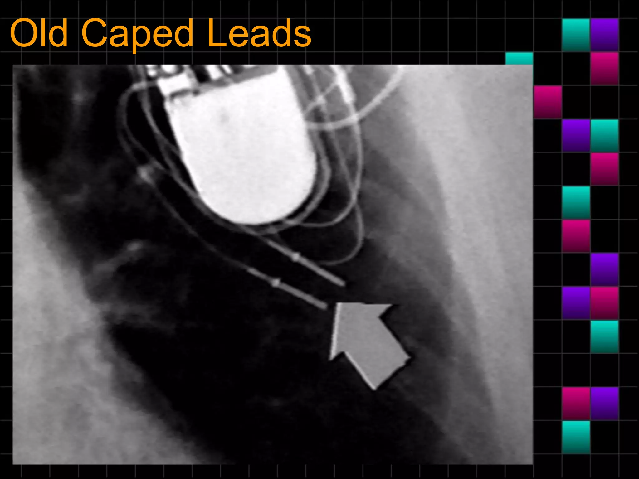 Pacemaker radiologyanintroduction | PPT
