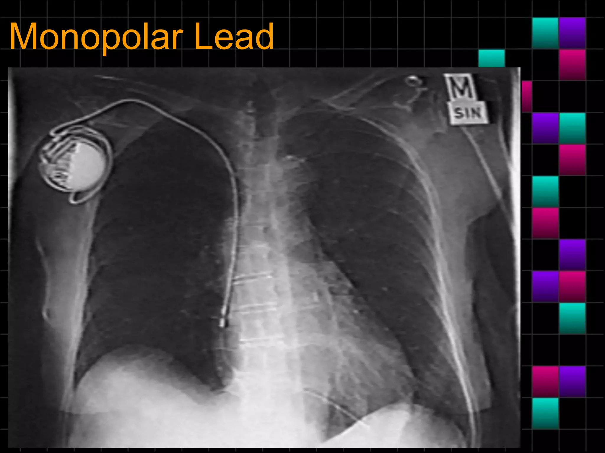 Pacemaker radiologyanintroduction | PPT