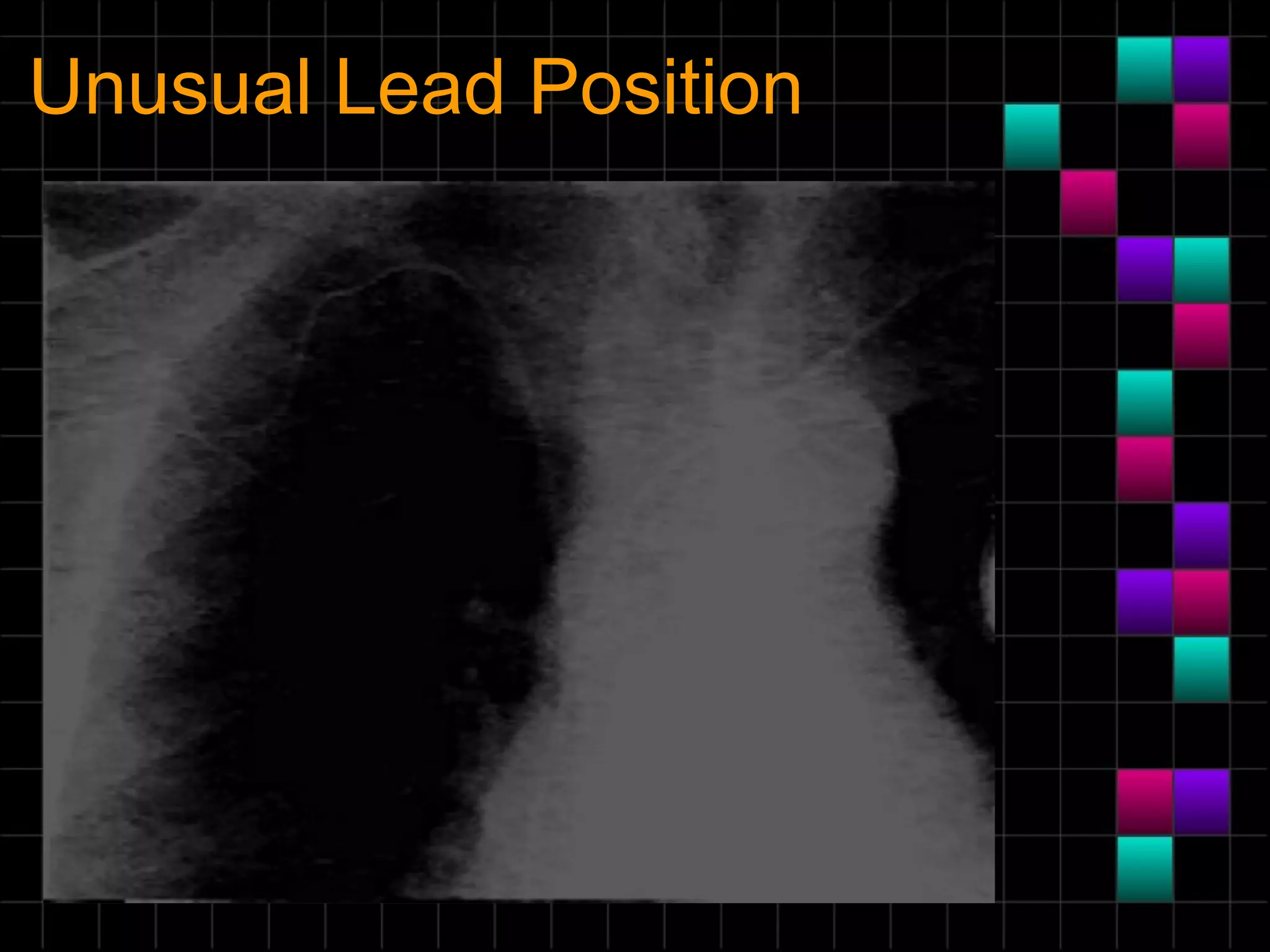 Pacemaker radiologyanintroduction | PPT