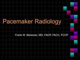 Pacemaker radiologyanintroduction | PPT
