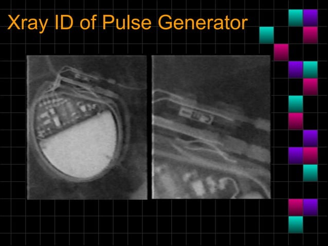 Pacemaker radiologyanintroduction | PPT