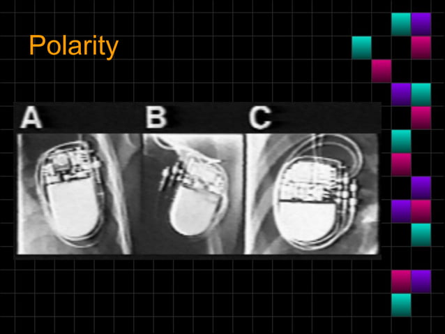 Pacemaker radiologyanintroduction | PPT