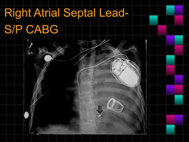 Pacemaker radiologyanintroduction | PPT